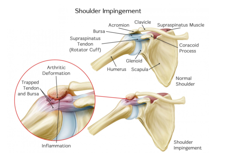 Shoulder Bursitis Physiotherapist Brisbane City Physio Therapy Shoulder Bursitis Physiotherapist Brisbane City Physio Therapy